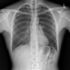 Bilateral Pneumothoraces After Trigger Point Injection Therapy: A Case ...
